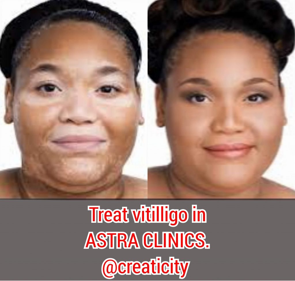 Best Albinism Treatment in Pune - Astra Clinics Pune