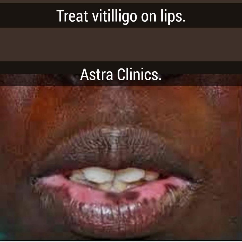 Best Albinism Treatment in Pune - Astra Clinics Pune