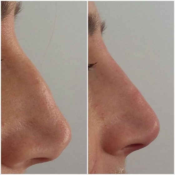 Non Surgical Nose Correction Treatment In Pune - Astra Clinics
